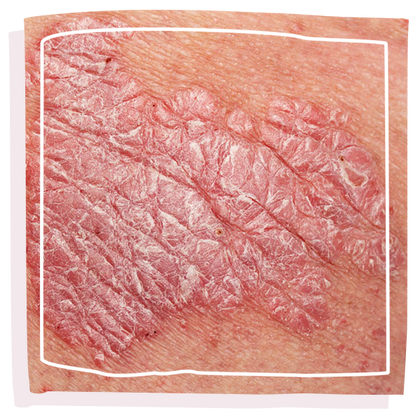 Psoriasis – Epaderm